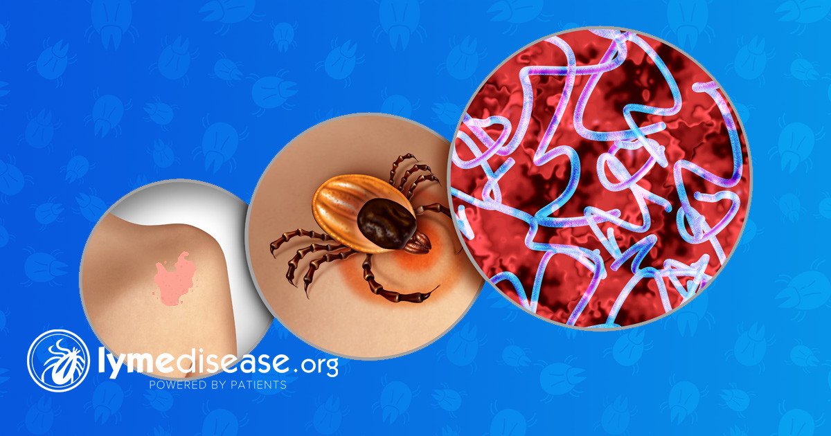 A Lyme Rash Doesn't Always Look Like a Bulls-eye Target