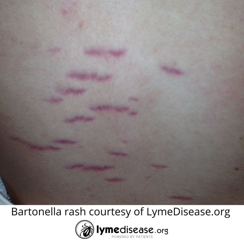 How prevalent is Bartonella in people who have Lyme disease?