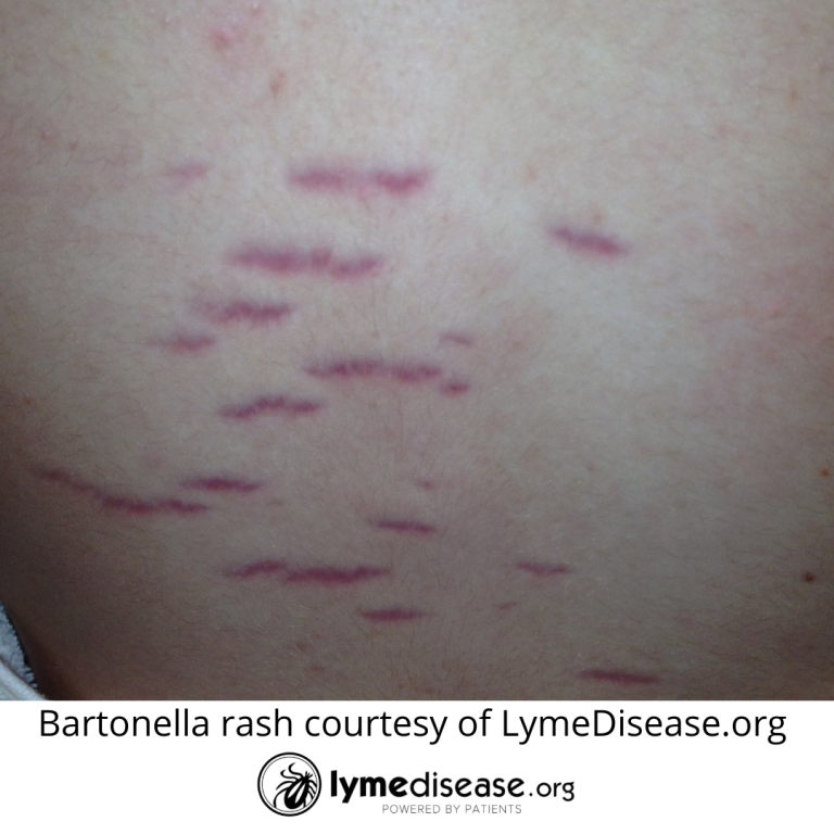 How prevalent is Bartonella in people who have Lyme disease?