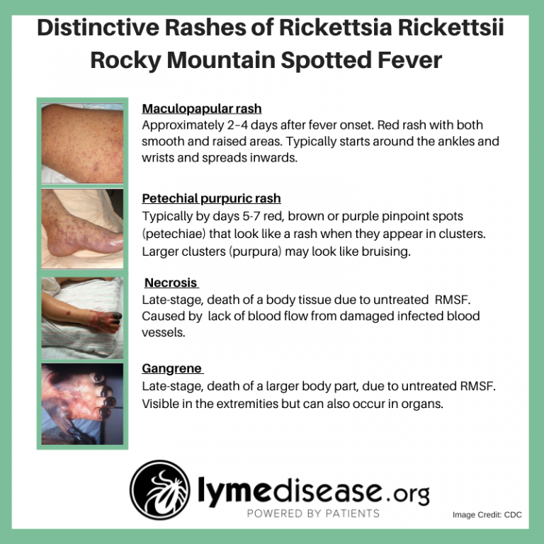 New rickettsial pathogen discovered in California