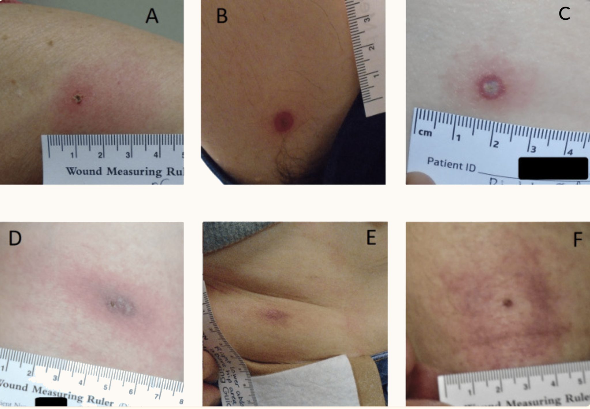 MEDICAL DETECTIVE #3: Let’s Talk About Lyme Rashes | LymeDisease.org