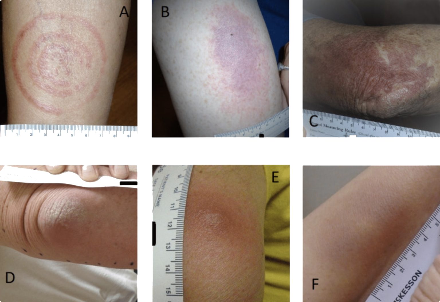 MEDICAL DETECTIVE #3: Let’s Talk About Lyme Rashes | LymeDisease.org