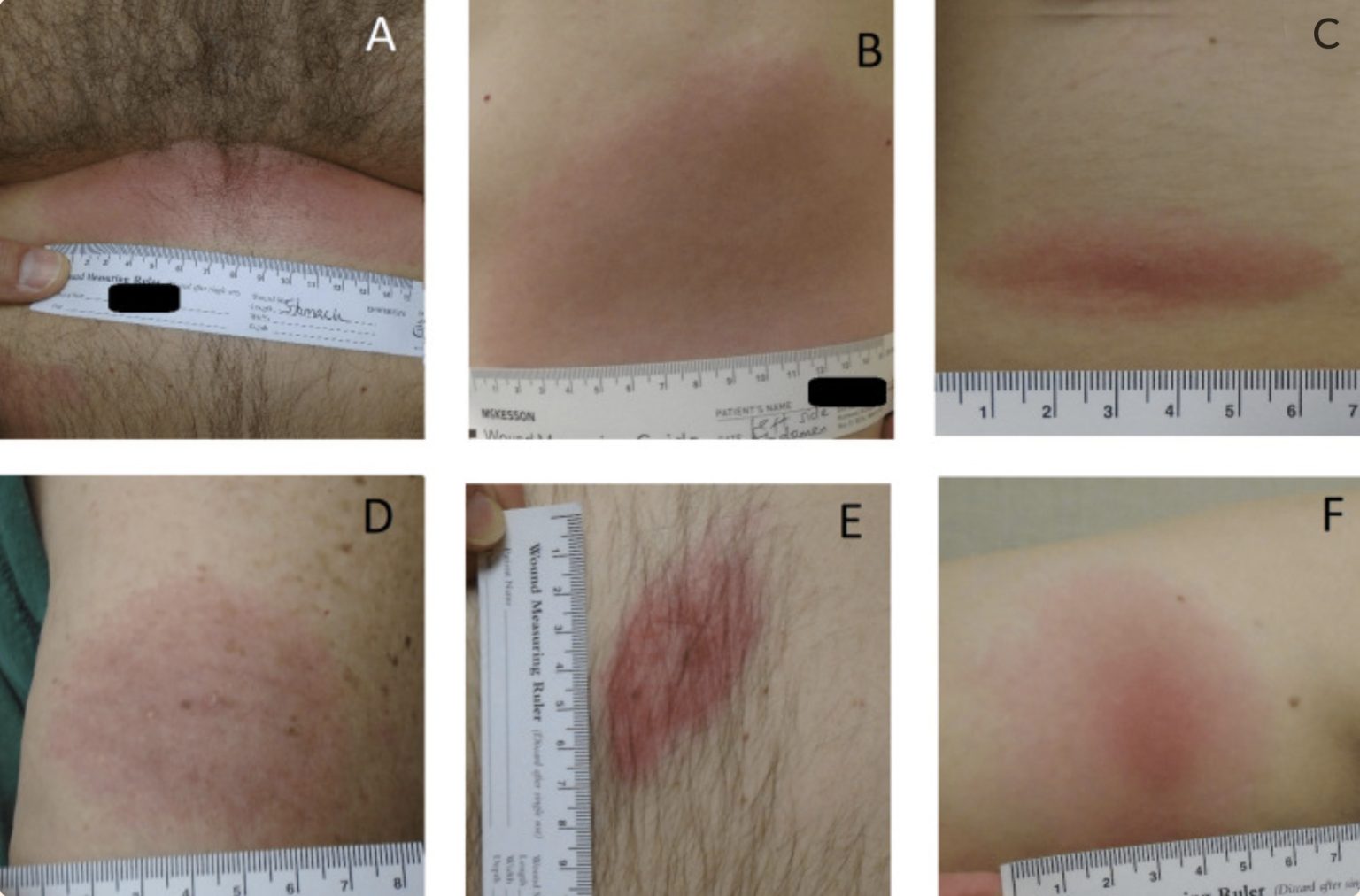 MEDICAL DETECTIVE #3: Let’s Talk About Lyme Rashes | LymeDisease.org
