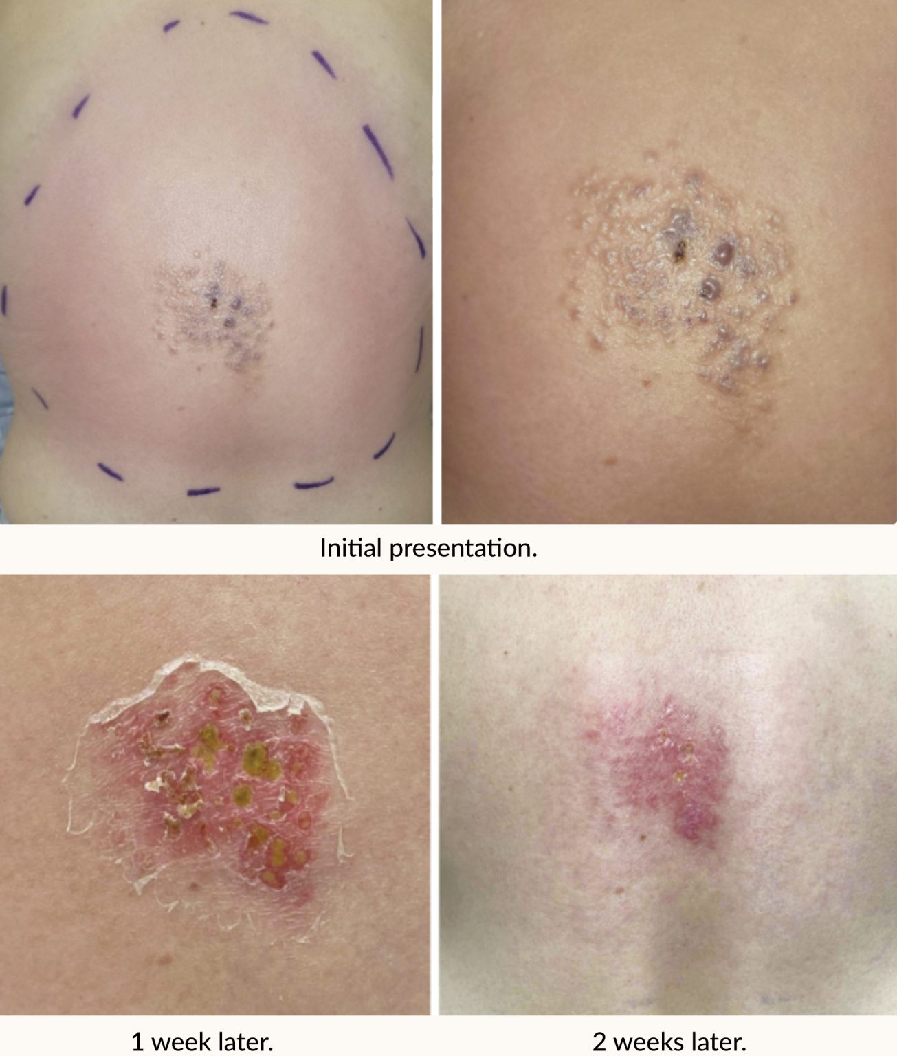 MEDICAL DETECTIVE #3: Let’s Talk About Lyme Rashes | LymeDisease.org