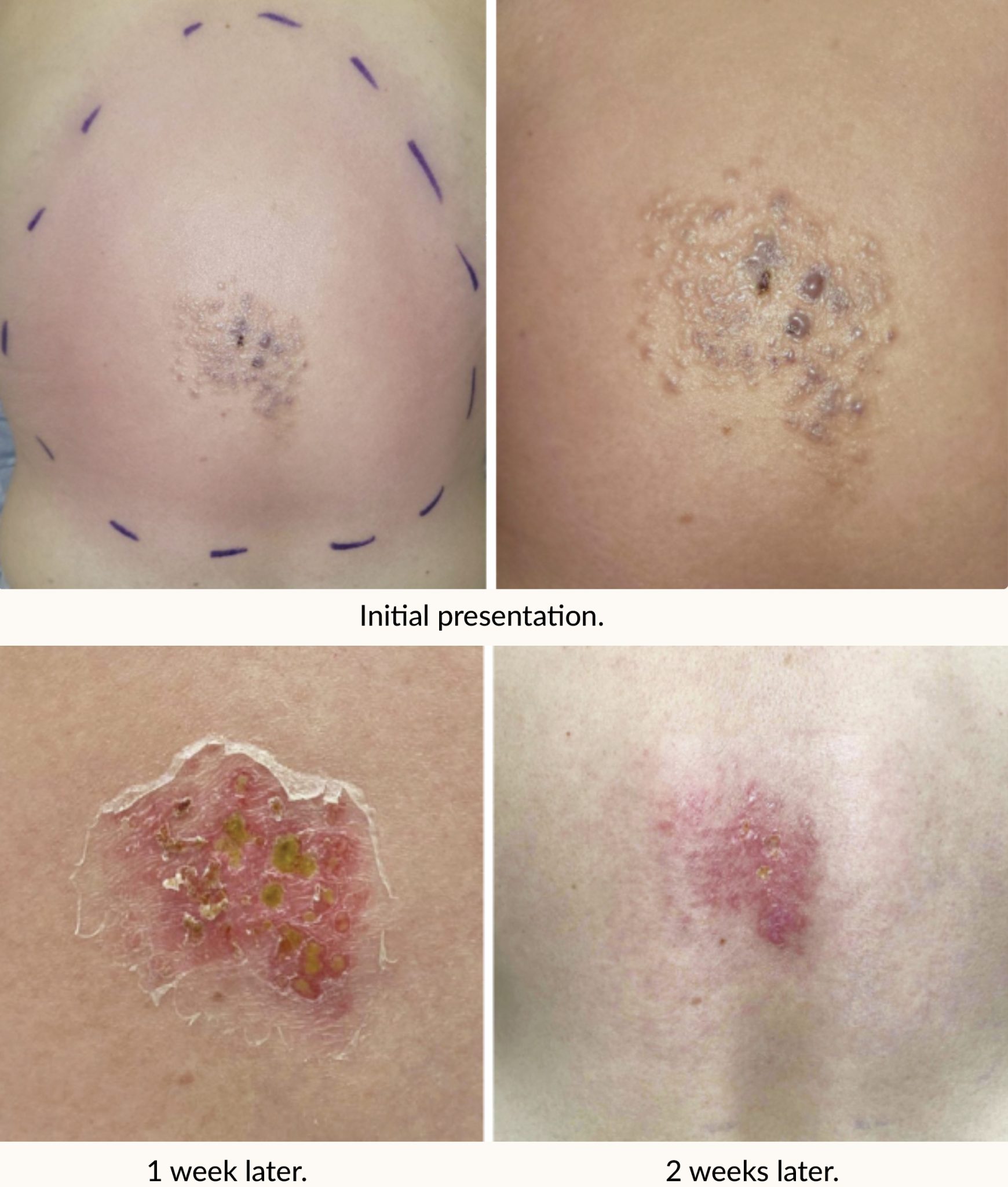 MEDICAL DETECTIVE #3: Let’s Talk About Lyme Rashes | LymeDisease.org