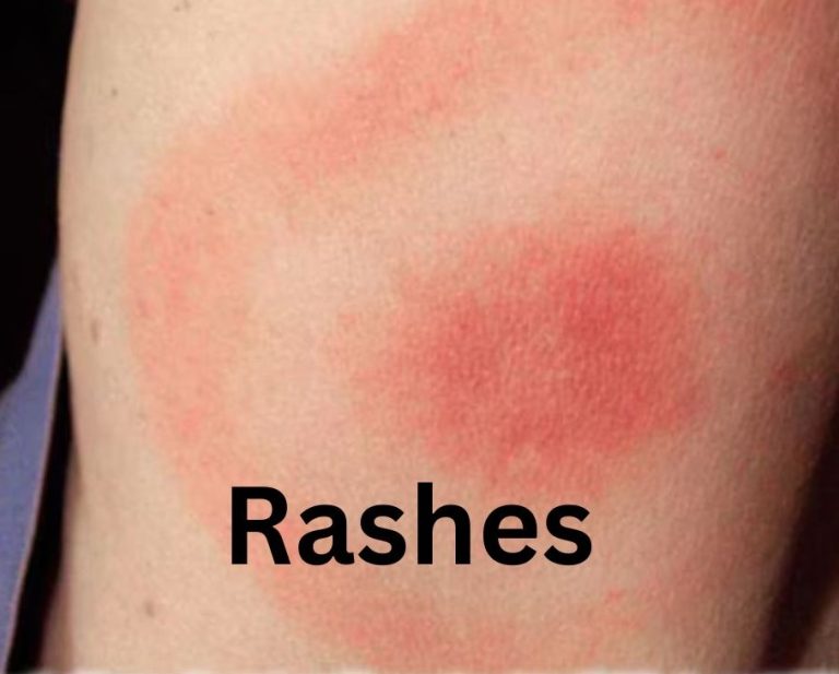 MEDICAL DETECTIVE #3: Let’s Talk About Lyme Rashes | LymeDisease.org